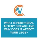 Peripheral Artery Disease Treatment Guide